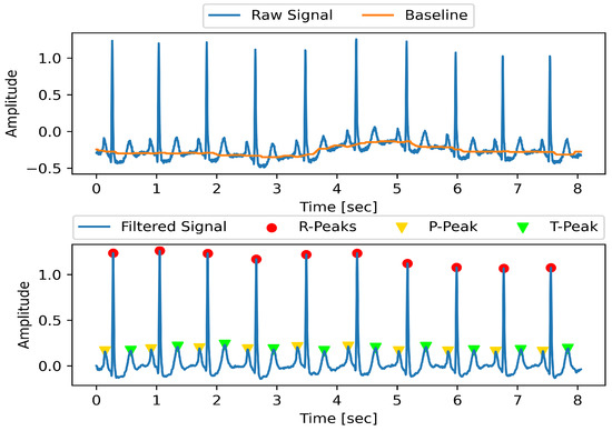 Cost-Sensitive Learning for Anomaly Detection in Imbalanced ECG Data ...