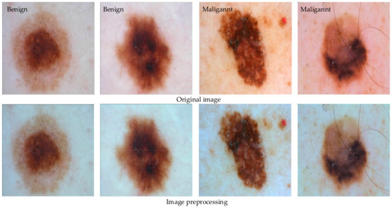 Dermoscopic Image Classification Method Using an Ensemble of Fine-Tuned Convolutional Neural ...