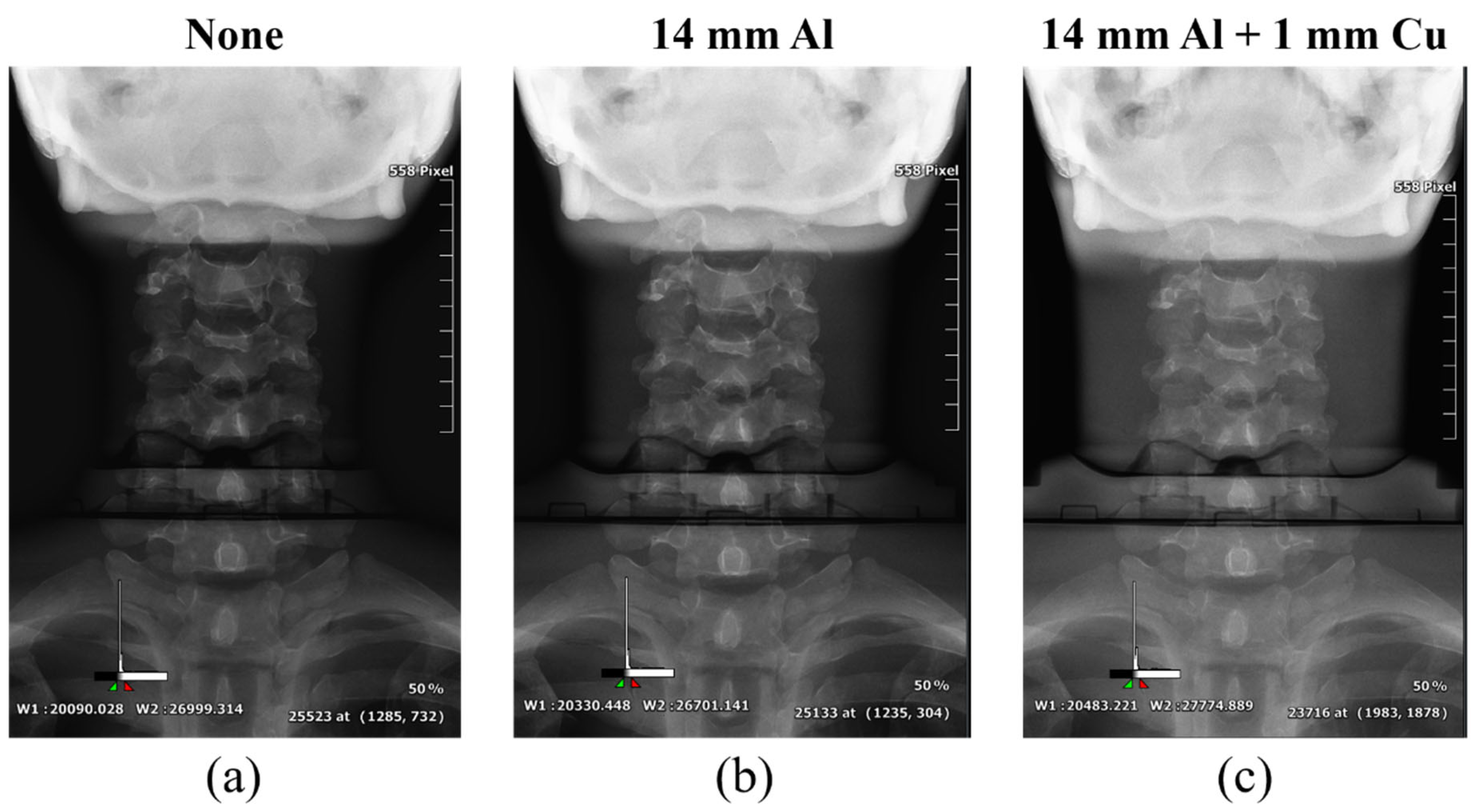 Usefulness of an Additional Filter Created Using 3D Printing for Whole ...