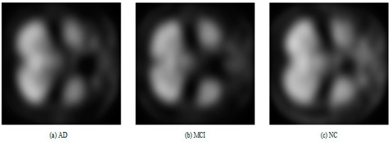 Early-Stage Alzheimer’s Disease Categorization Using PET Neuroimaging ...