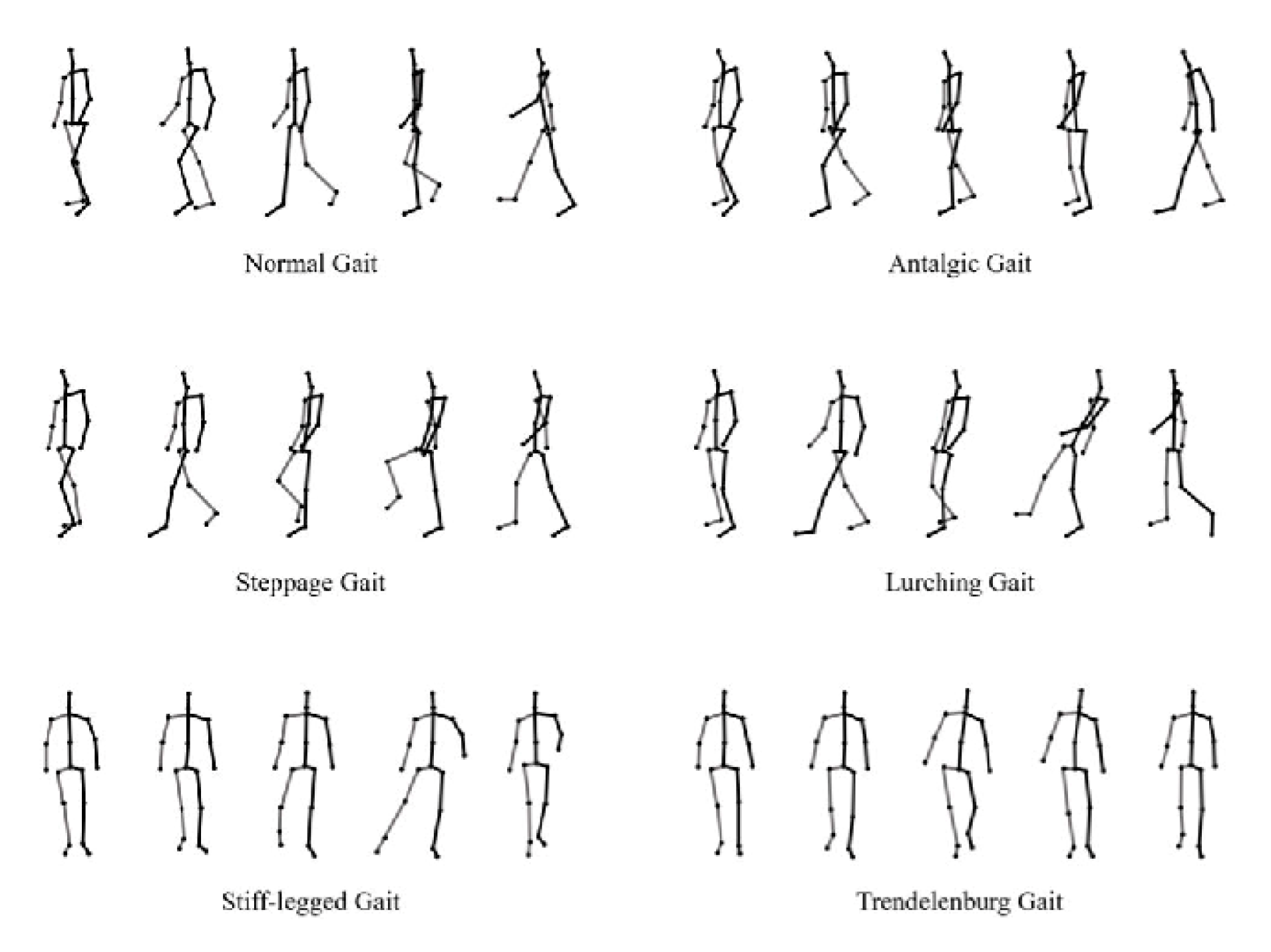 Pathological-Gait Recognition Using Spatiotemporal Graph Convolutional Networks and Attention Model
