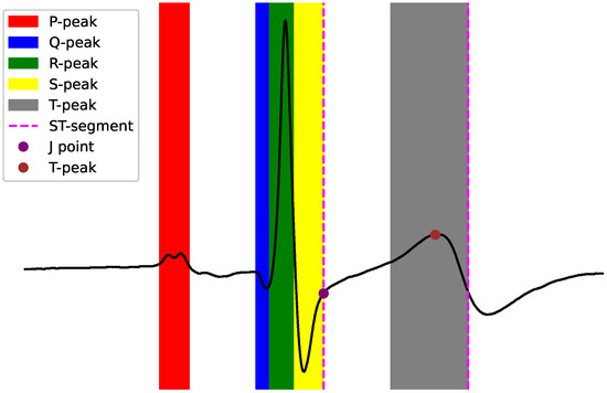 Interpretable Assessment of ST-Segment Deviation in ECG Time Series