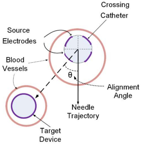 Electric-Field-Based Guidance for Percutaneous Catheter Vessel Crossing