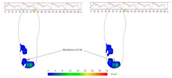 Estimation of Tibiofemoral Joint Contact Forces Using Foot Loads during ...