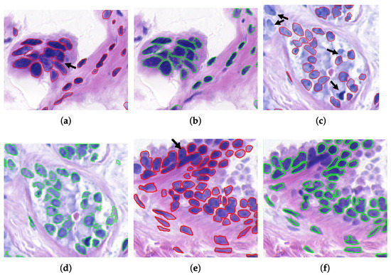 Characterization of Nuclear Pleomorphism and Tubules in ...