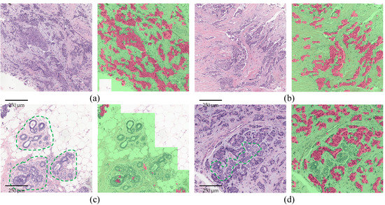 Using Sparse Patch Annotation for Tumor Segmentation in Histopathological Images