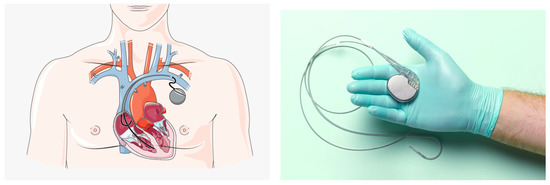Computational Analysis of a Multi-Layered Skin and Cardiac Pacemaker ...