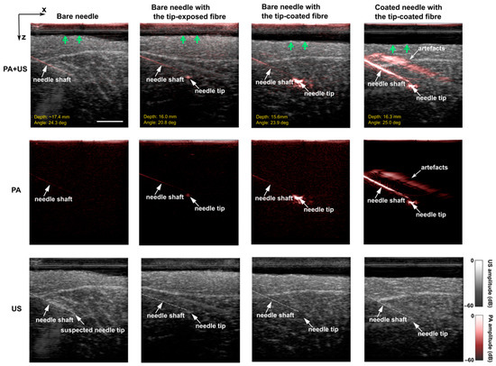 Enhanced Photoacoustic Visualisation of Clinical Needles by Combining ...