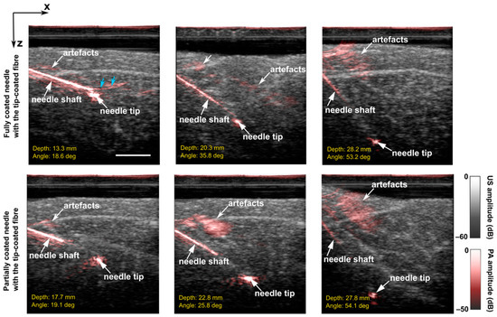 Enhanced Photoacoustic Visualisation of Clinical Needles by Combining ...
