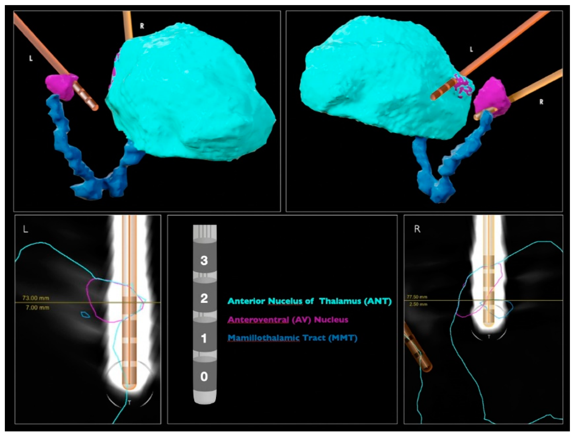 Sensors | Free Full-Text | Estimation of ANT-DBS Electrodes on Target ...