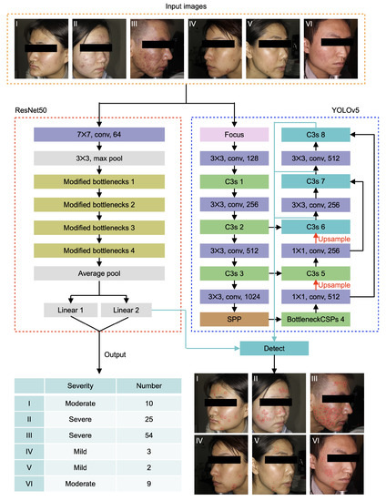 Acne Detection by Ensemble Neural Networks