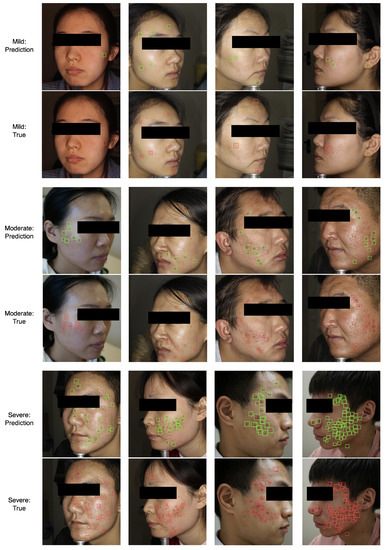 Acne Detection by Ensemble Neural Networks