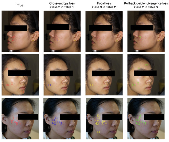 Sensors | Free Full-Text | Acne Detection by Ensemble Neural Networks
