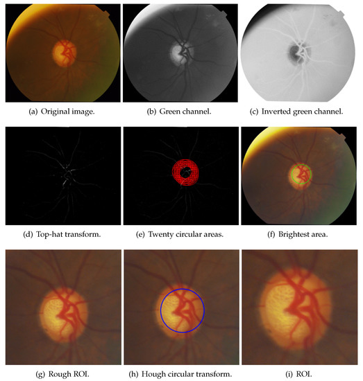 Multiple Preprocessing Hybrid Level Set Model For Optic Disc