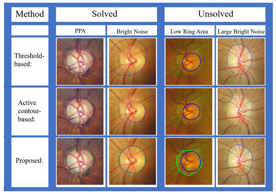 Multiple Preprocessing Hybrid Level Set Model for Optic Disc ...