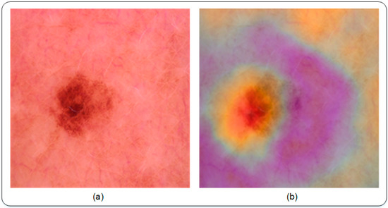 Classification of Skin Cancer Lesions Using Explainable Deep Learning