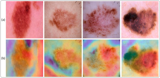 Classification of Skin Cancer Lesions Using Explainable Deep Learning