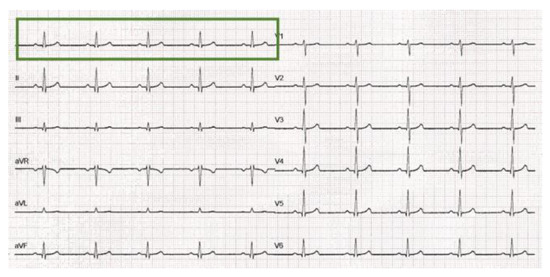 Development and Validation of an Algorithm for the Digitization of ECG Paper Images