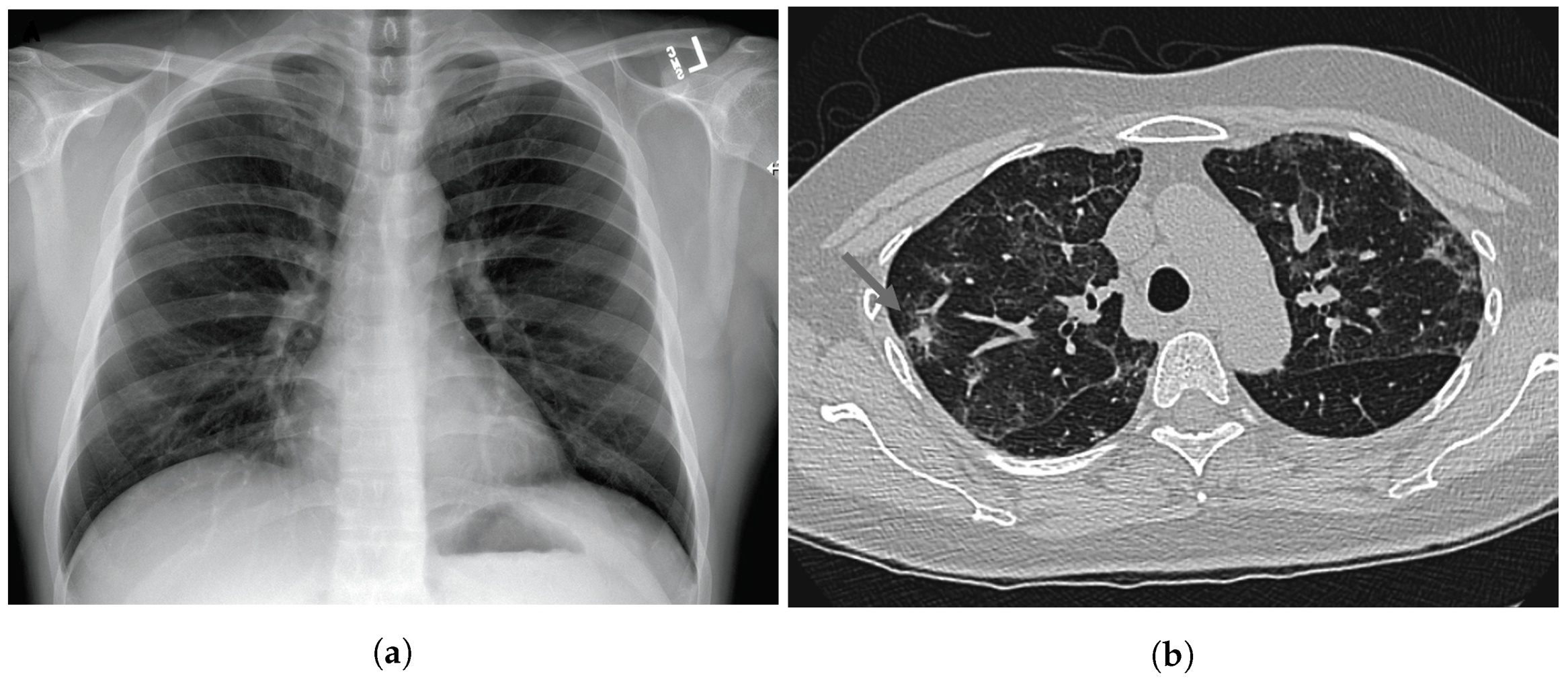 Sensors | Free Full-Text | COVID-19 Detection on Chest X-ray and CT ... Sensors | Free Full-Text | COVID-19 Detection on Chest X-ray and CT ...