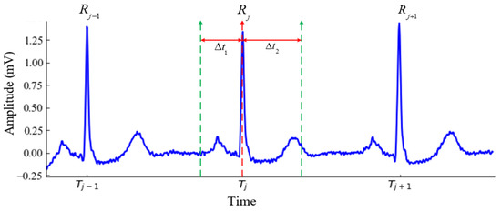 A Parallel Cross Convolutional Recurrent Neural Network for Automatic Imbalanced ECG Arrhythmia ...