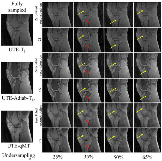 Accelerated Quantitative 3D UTE-Cones Imaging Using Compressed Sensing