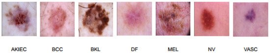 Skin Lesion Classification on Imbalanced Data Using Deep Learning with ...