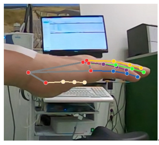 Video-Based Hand Movement Analysis of Parkinson Patients before and ...