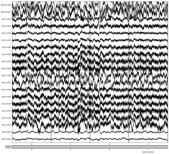 Brain Age Prediction/Classification through Recurrent Deep Learning ...