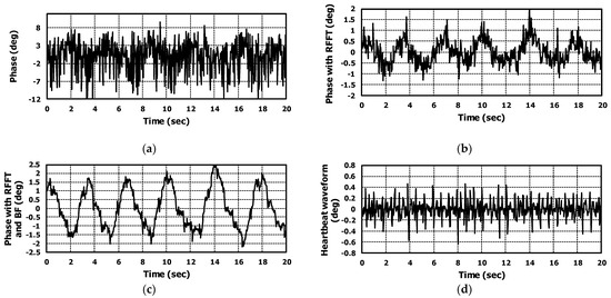 Non-Contact VITAL Signs Monitoring of a Patient Lying on Surgical Bed ...