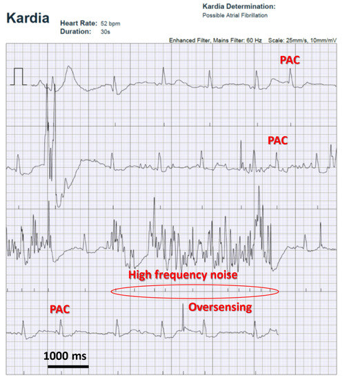 Wearable Devices for Remote Monitoring of Heart Rate and Heart Rate ...