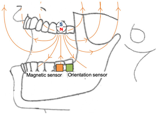 A New Intraoral Six-Degrees-of-Freedom Jaw Movement Tracking Method ...