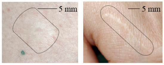 Mueller Matrix Microscopy for In Vivo Scar Tissue Diagnostics and ...