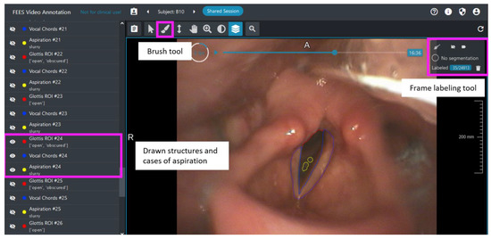 AI-Based Detection of Aspiration for Video-Endoscopy with Visual Aids in Meaningful Frames to ...