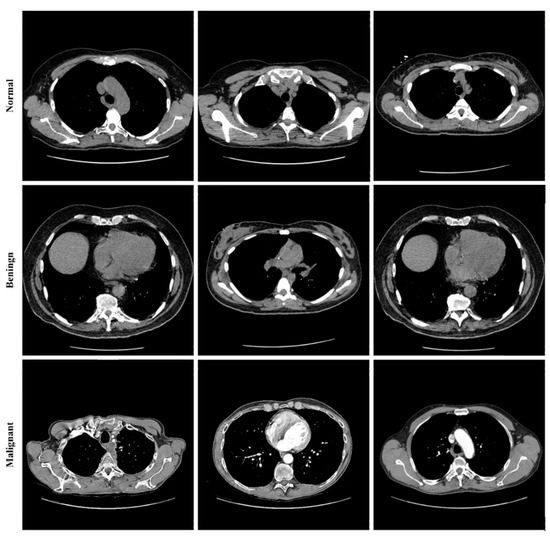 IGWO-IVNet3: DL-Based Automatic Diagnosis of Lung Nodules Using an ...