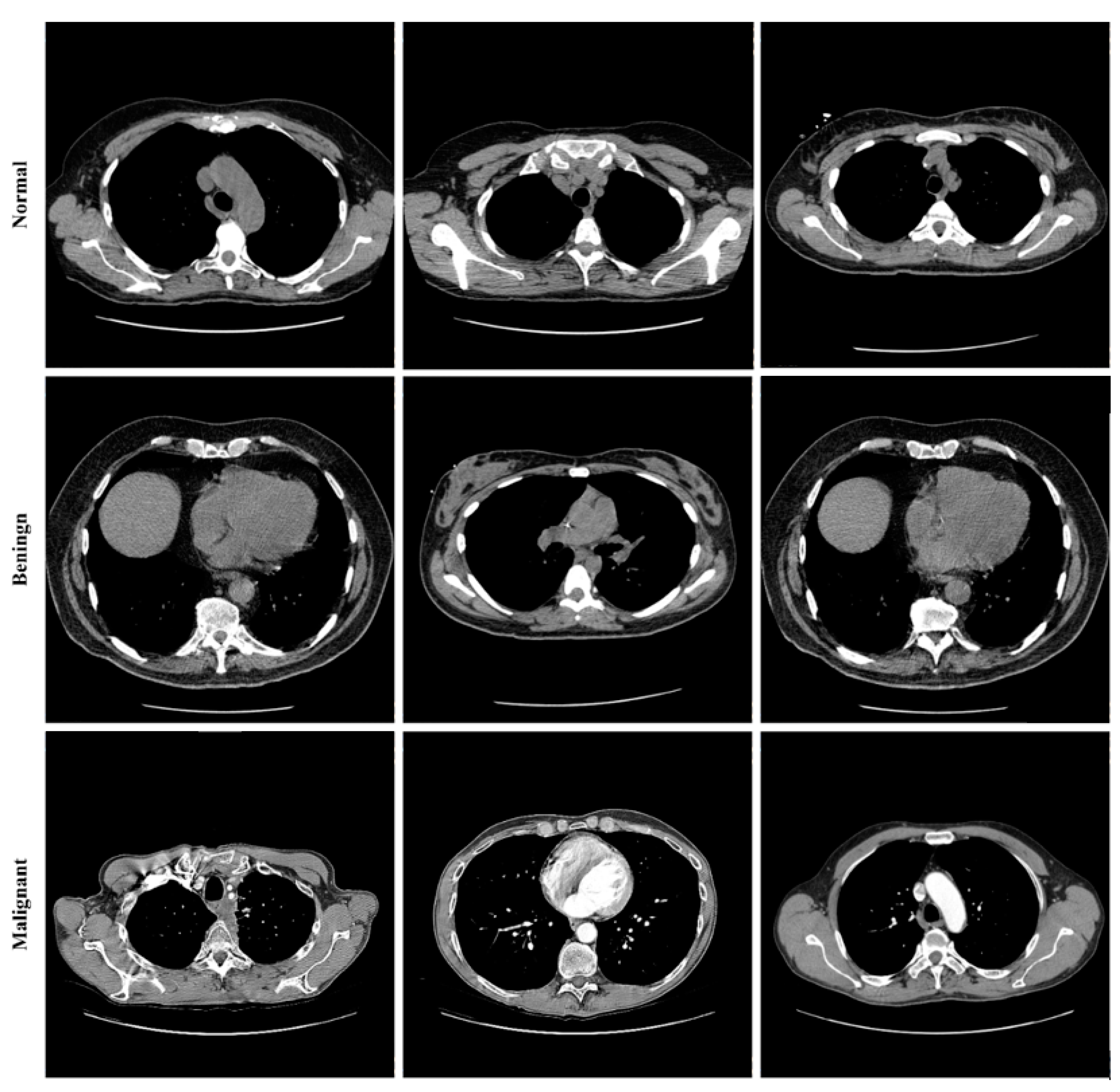 IGWO-IVNet3: DL-Based Automatic Diagnosis of Lung Nodules Using an Improved Gray Wolf ...