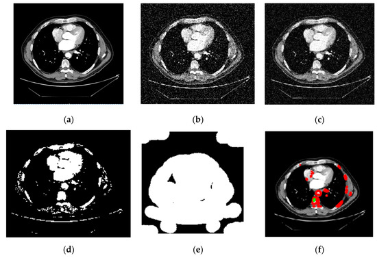 IGWO-IVNet3: DL-Based Automatic Diagnosis of Lung Nodules Using an ...