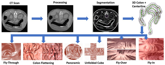 An AI-Based Colonic Polyp Classifier for Colorectal Cancer Screening ...