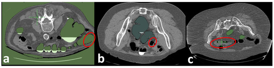 An AI-Based Colonic Polyp Classifier for Colorectal Cancer Screening ...