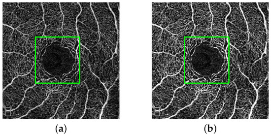 Retinal OCTA Image Segmentation Based on Global Contrastive Learning