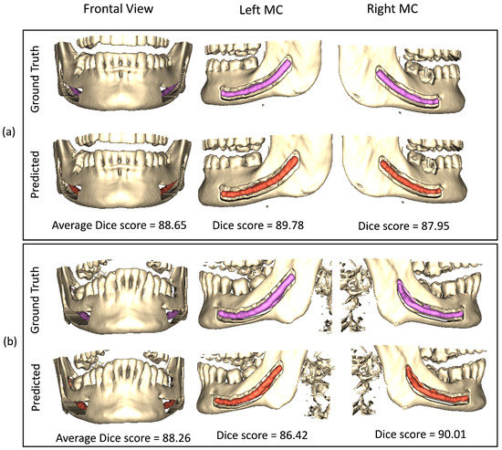 Dual-Stage Deeply Supervised Attention-Based Convolutional Neural Networks for Mandibular Canal ...