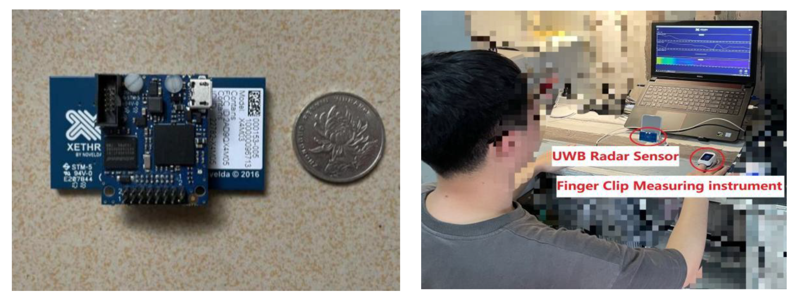 SSA-VMD for UWB Radar Sensor Vital Sign Extraction