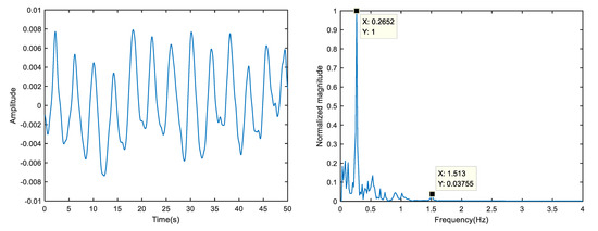SSA-VMD for UWB Radar Sensor Vital Sign Extraction