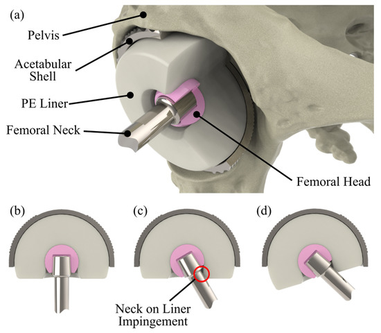 Inertial Tracking System for Monitoring Dual Mobility Hip Implants In Vitro