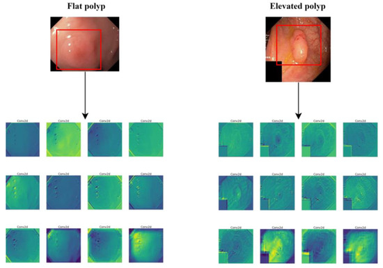 Detection of Colorectal Polyps from Colonoscopy Using Machine Learning: A Survey on Modern ...