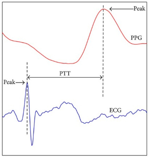 Hybrid CNN-SVR Blood Pressure Estimation Model Using ECG and PPG Signals