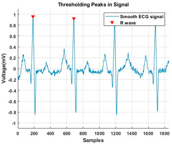 Hybrid CNN-SVR Blood Pressure Estimation Model Using ECG and PPG Signals