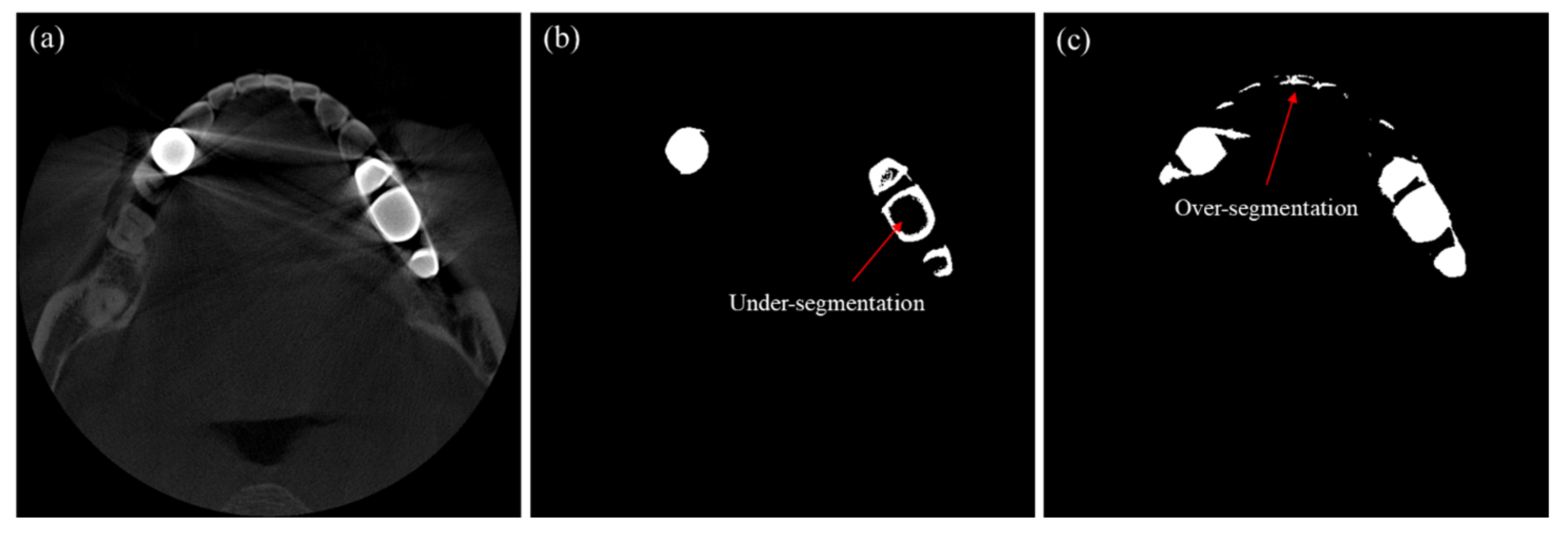 Metal Artifact Reduction in Dental CBCT Images Using Direct Sinogram ...