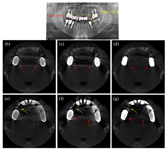 Metal Artifact Reduction in Dental CBCT Images Using Direct Sinogram ...