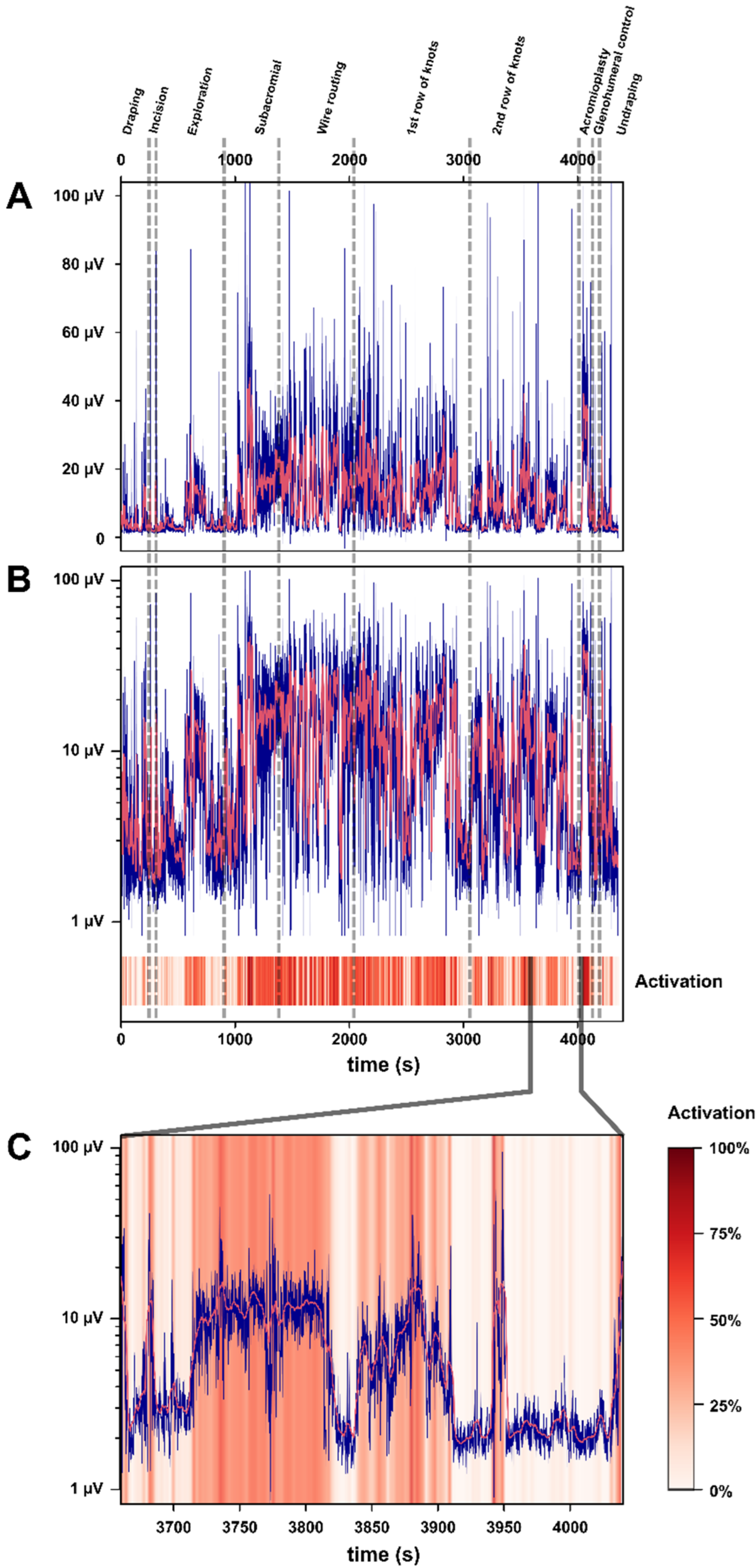 A New Approach to Quantifying Muscular Fatigue Using Wearable EMG Sensors during Surgery: An ...