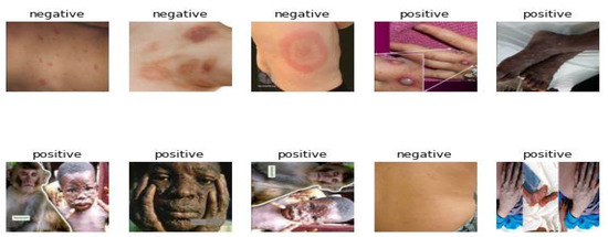 Monkeypox Detection Using CNN with Transfer Learning